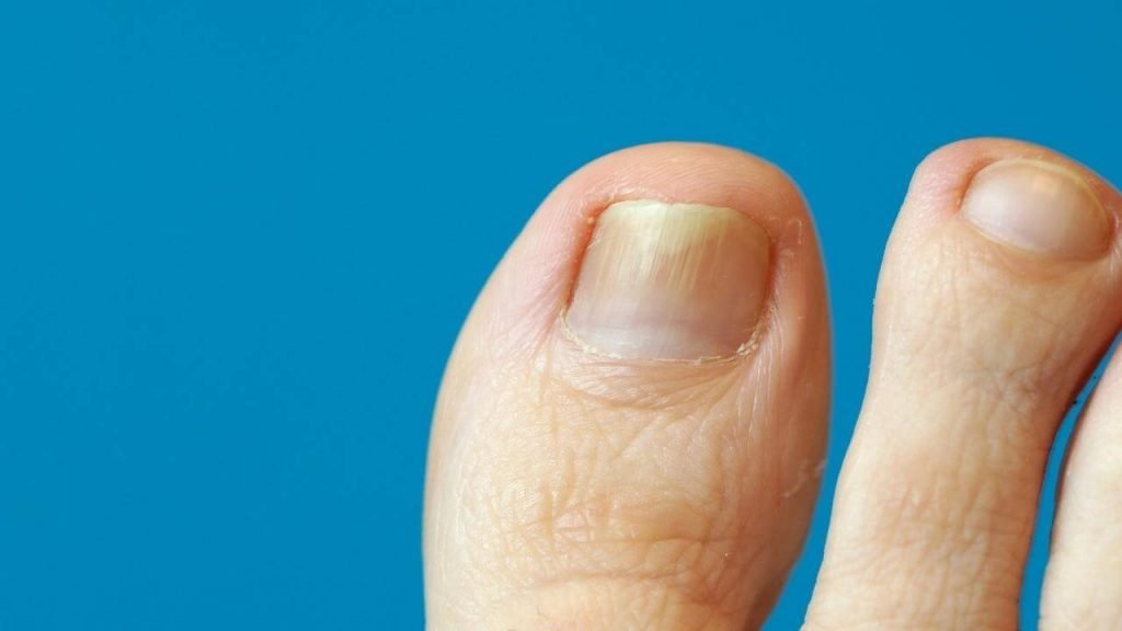 Psoriasi Ungueale | Quando la psoriasi colpisce le unghie.