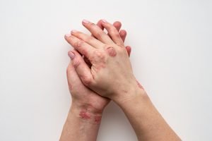 Tipi di Psoriasi - Psoriasi